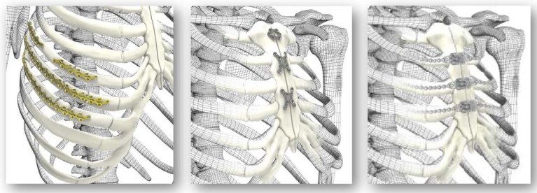 Combined image - Chest Wall Injury Society