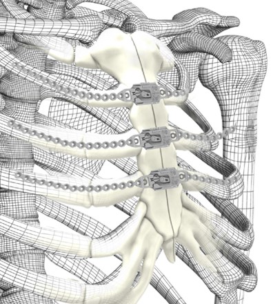Recon Talon- CWIS – Chest Wall Injury Society