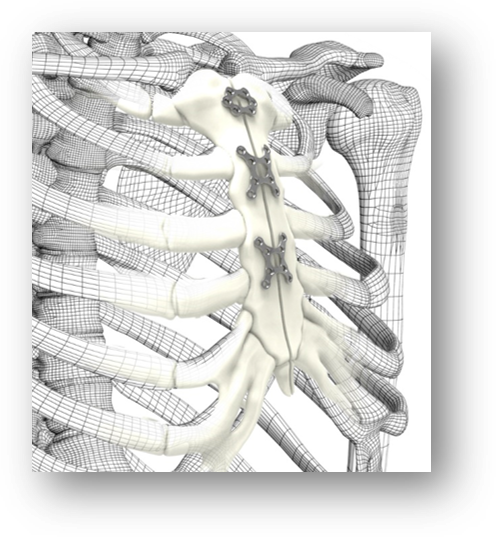 Sternal Wire- CWIS – Chest Wall Injury Society